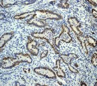 Mismatch Repair (MSH6, PMS2, MLH1, MSH2) Antibody Panel - Human ...