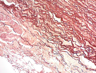 Orcein Stain Kit (Hepatitis B and Elastic Fibers) (ab245881) | Abcam